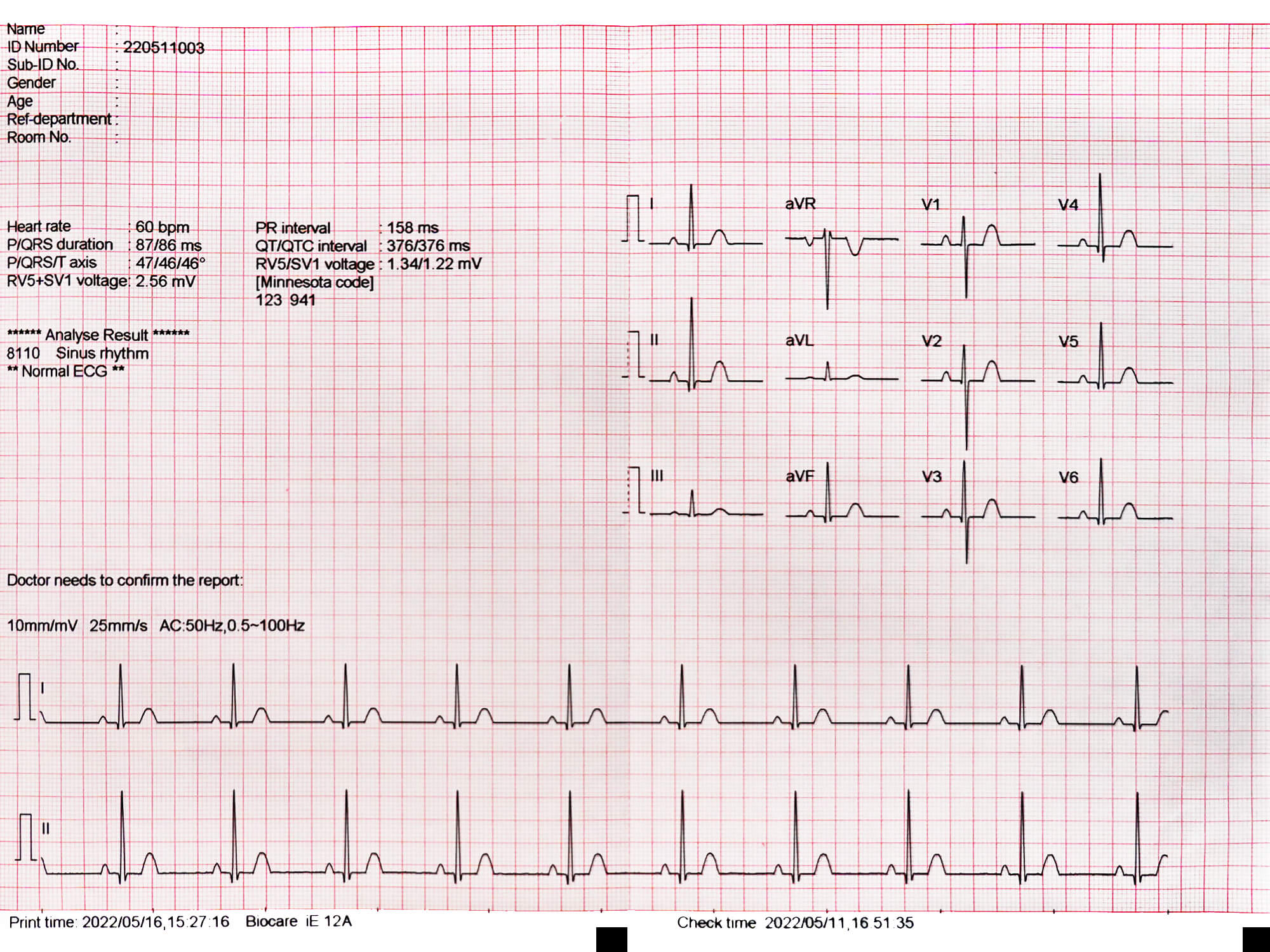 12 channel ECG report of Biocare iE12A ECG machine | Wellue Blog